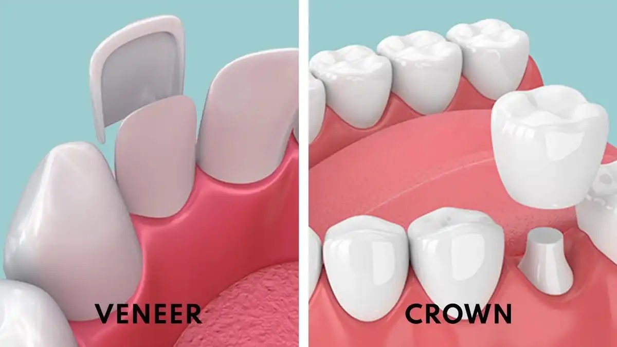 Understanding Crowns vs. Veneers: Which is Right for You? — Village Dental